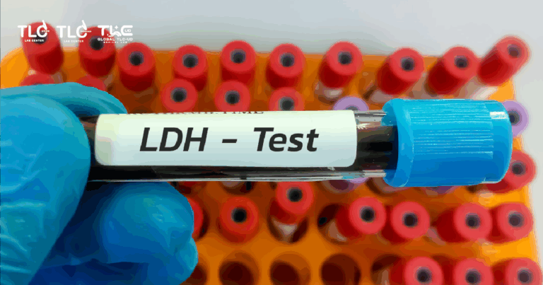 Lactate Dehydrogenase บ่งชี้อะไรบ้าง? - TLC Udon Lab Center